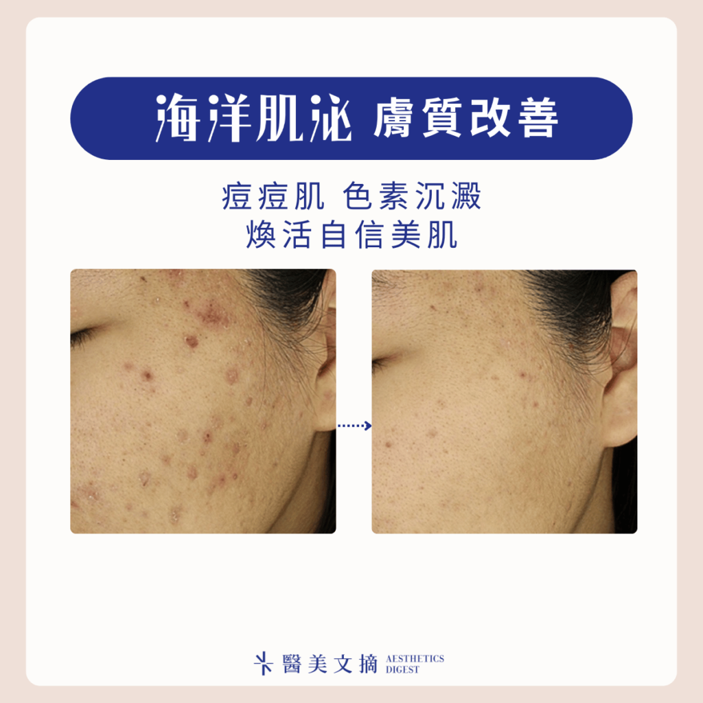 2025 革命性保養全能之選！「海洋肌泌 EXOCEAN」讓你重拾透潤嫩白年輕肌 - 醫美文摘