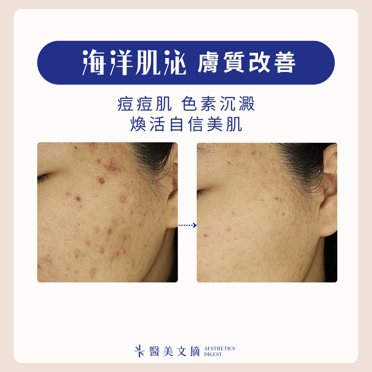 2025 革命性保養全能之選！「海洋肌泌 EXOCEAN」讓你重拾透潤嫩白年輕肌 - 醫美文摘