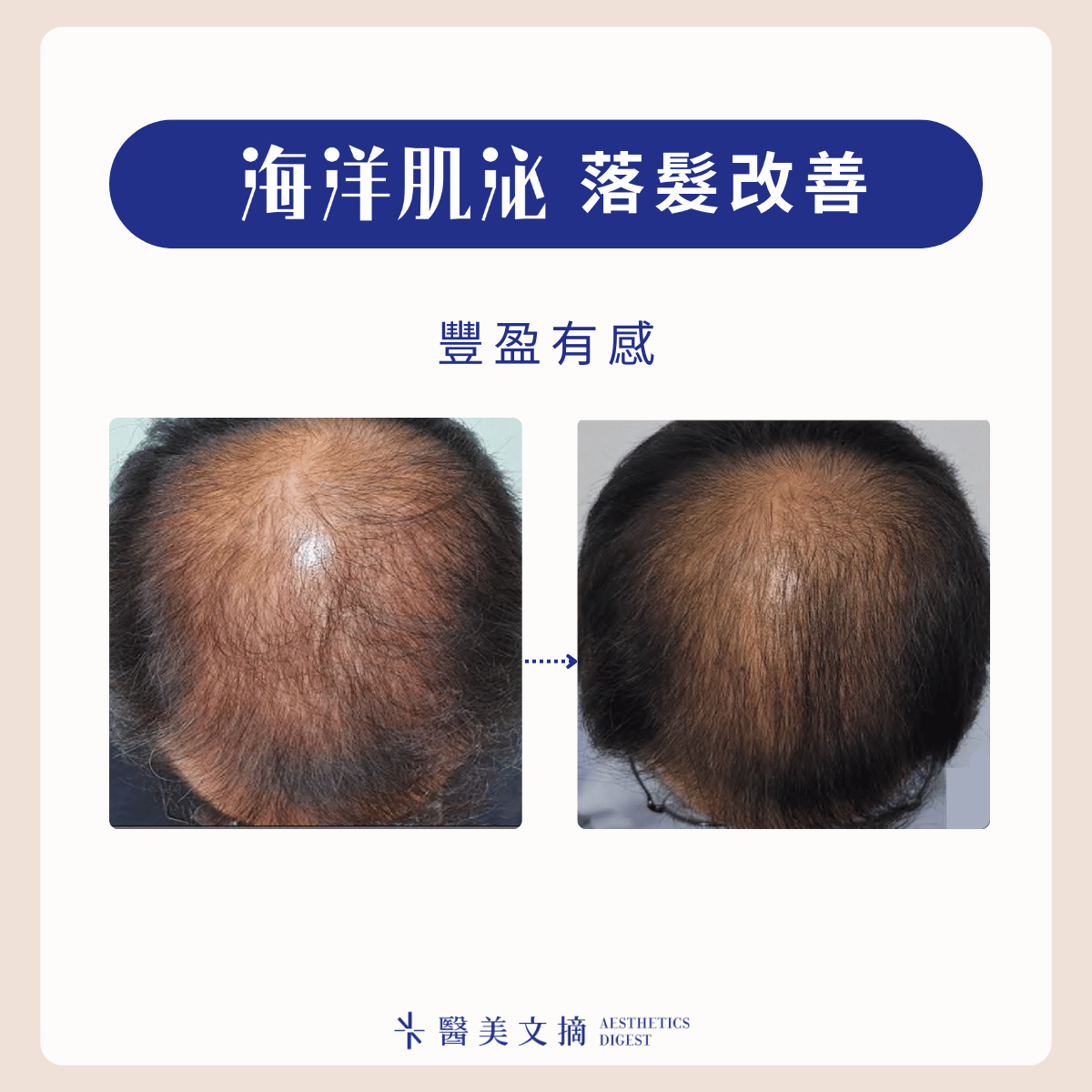 2025 革命性保養全能之選！「海洋肌泌 EXOCEAN」讓你重拾透潤嫩白年輕肌 - 醫美文摘